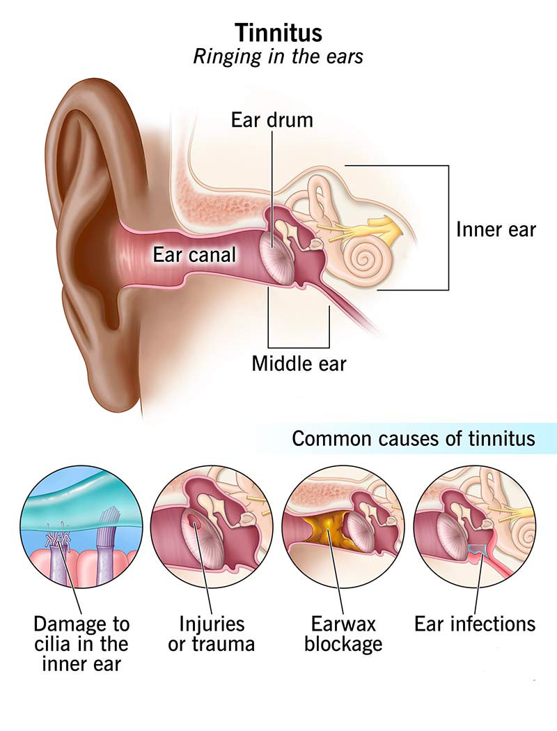 Understanding Tinnitus Navigating The World Of Phantom Sounds